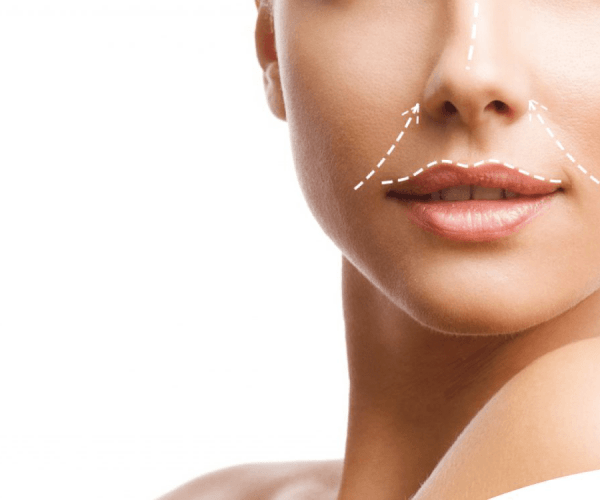 Sillons nasogénien - The Essential Clinic